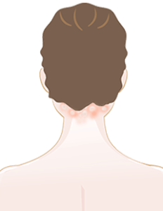 Hoofdschimmel → Zo kom je van schimmel op de hoofdhuid af